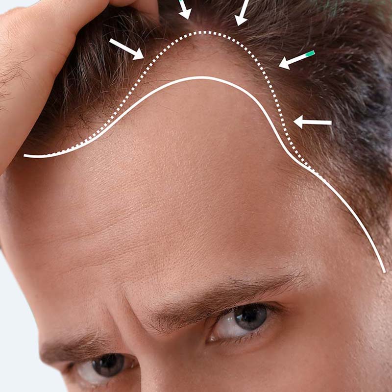 Hair Smart Regrowth: Advanced Hair Restoration Solutions - Ai Gaia ...